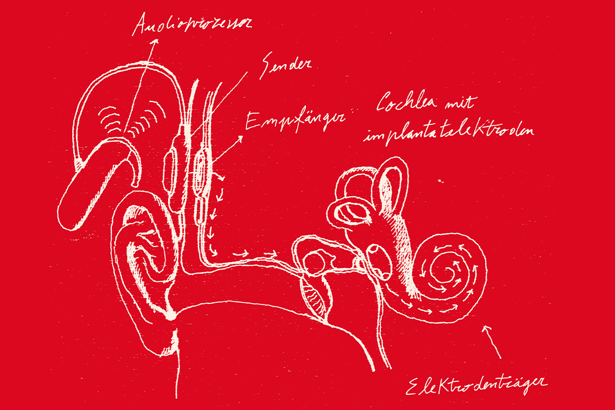 BONEBRIDGE Bone Conduction Implant - hearbetter