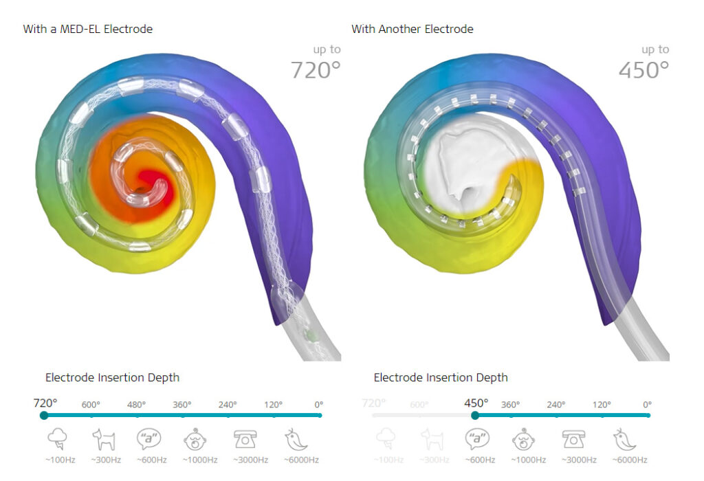 Close to natural hearing – what does it need? - hearbetter